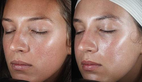 Introducing SilkPeel® Dermalinfusion at Pure Dermatology Denver